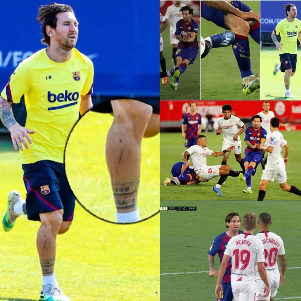 (FOTO) Así quedó la pierna de Messi tras la dura entrada de Diego ...